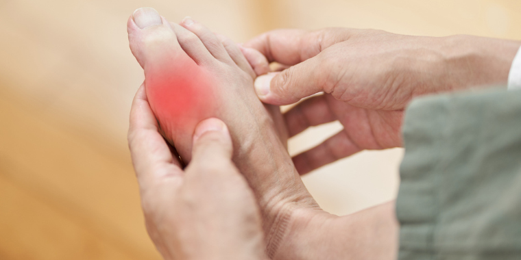 Prévenir les crises de goutte naturellement - Annuaire Thérapeutes